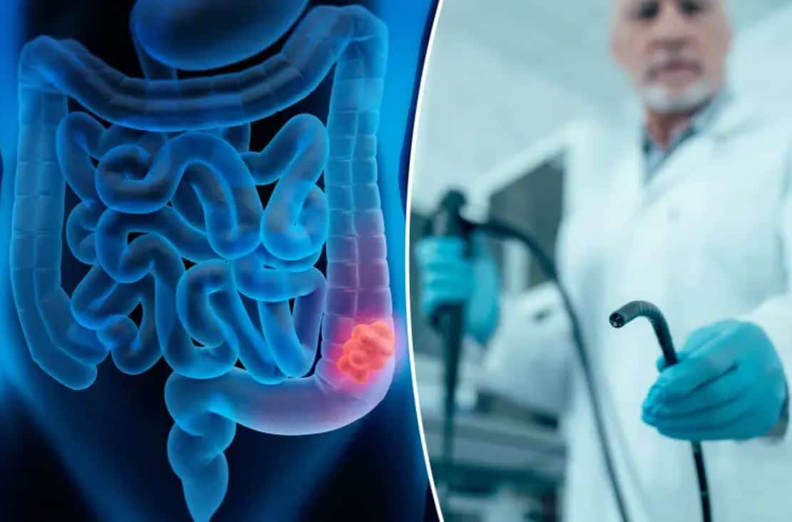 Does Medicare Cover A Colonoscopy? | Stay Informed & Healthy - Social ...